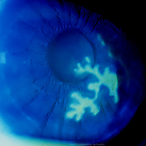 Herpes simplex keratitis - COS