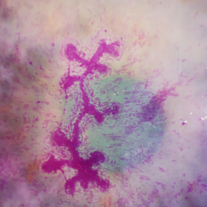 Herpes simplex keratitis - COS